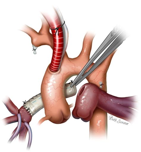 A Technique The American Association For Thoracic Surgery Aats