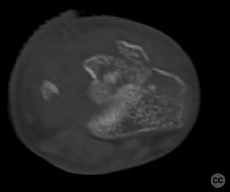 Radiocarpal Distraction Reduction Technique For Distal Radius Fracture