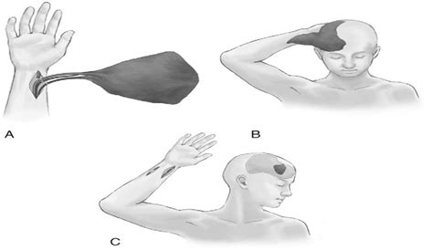 A Large Scalp Defect Coverage With Pedicled Free Flap Using Journal Of Craniofacial Surgery
