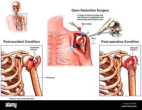 Impacted Fracture Humerus