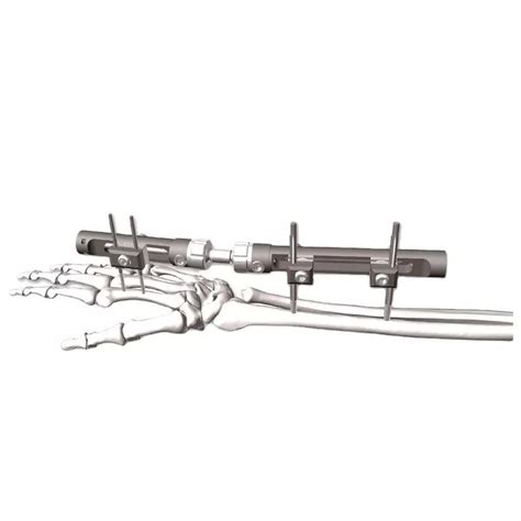 Orthopedic External Fixation Wrist Joint Distal Radius Fixator China Medical And Surgical