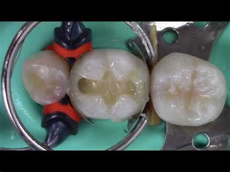 Class II Composite Restoration Video MEDtube Net