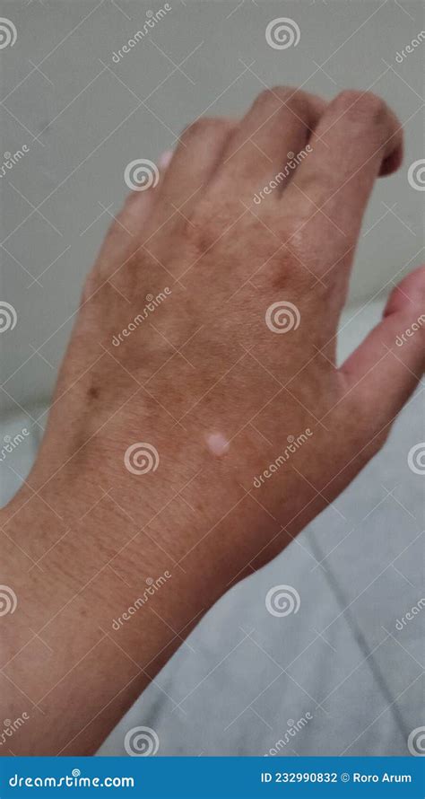 My Hand The Skin Color Is Different And There Are Abnormalities Stock Photo Image Of Fingers