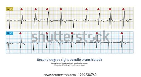 Complete Right Bundle Branch Block Appears Stock Illustration Shutterstock
