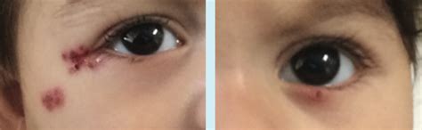 Atypical Presentation Of Orbital Herpes Simplex Virus Infection