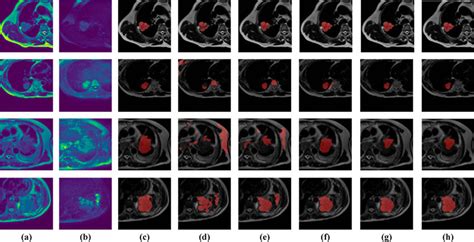 qualitative results of different multi modal tumor segmentation methods