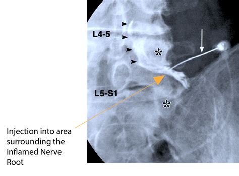 Nerve Root Blocks Rajiv Bajekal