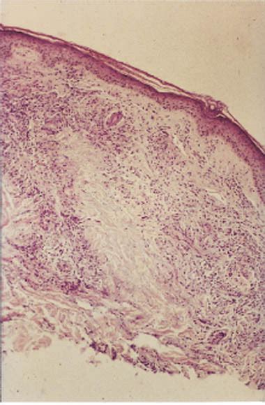 Anetoderma Secondary To Generalized Granuloma Annulare Journal Of The American Academy Of