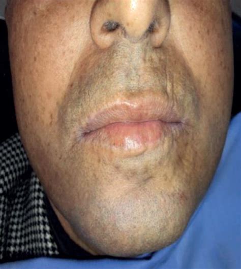 Front View Slight Facial Erythrosis Download Scientific Diagram