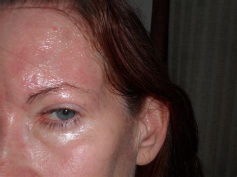 Photos Of Shingles On The Face Nylyma74