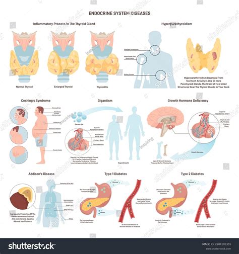 Endocrine Disorders