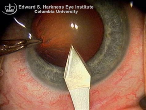 Clear Corneal Incision Vagelos College Of Physicians And Surgeons