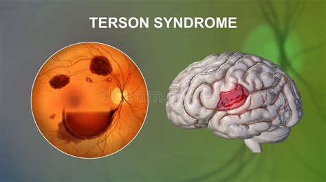 A 3d Illustration Of Terson Syndrome Revealing Intraocular Hemorrhage