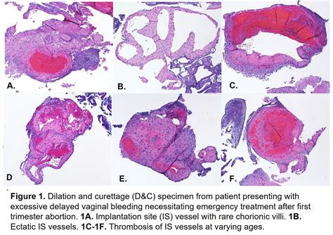 1001 Subinvolution Of The Placental Implantation Site Is It An