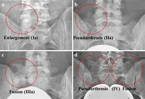 Classification Of Patients With Lstv According To Castellvi¹² Download Scientific Diagram