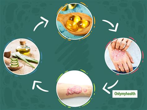 Plaque Psoriasis Scalp Home Remedy Homemade Ftempo