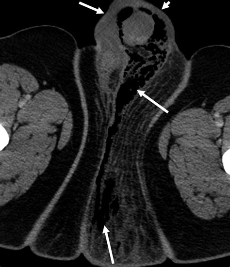 Fournier Gangrene Role Of Imaging Radiographics