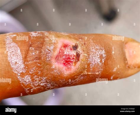 An Abscess That Was Drained From Pus And Cleaned Surgically For Dressing And Cleaning With