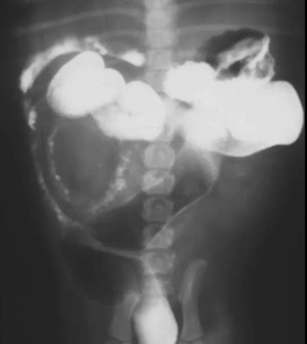 Intestines 20 Functional Ileus Flashcards Quizlet