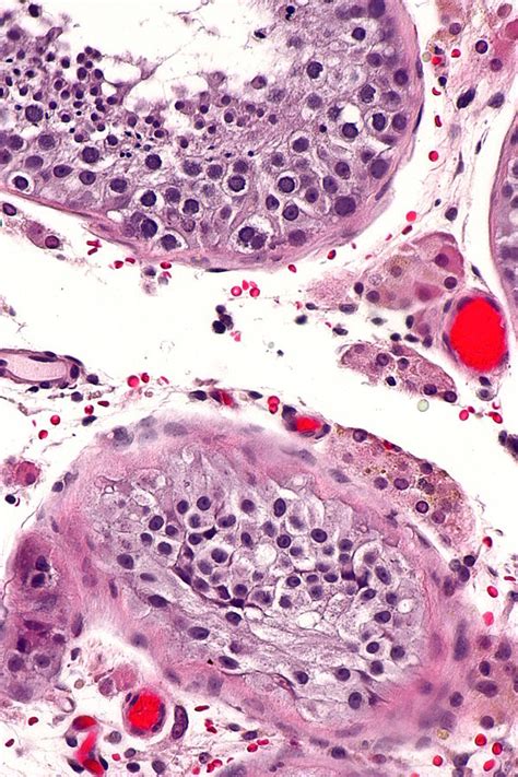 Testicular Atrophy Libre Pathology