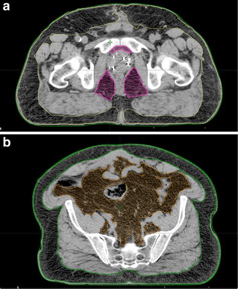 Adipose Tissue Measurements A Periprostatic Fat Pink And