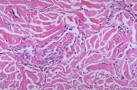 Kaposi Sarcoma Histology Classic Kaposis Sarcoma Presenting In The