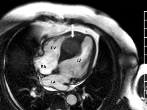Case 274 Cardiac Echinococcus Radiology