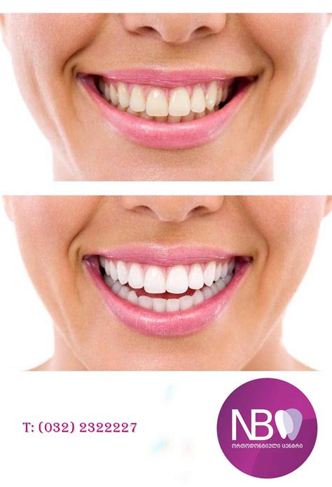 რა მეთოდები არსებობს კბილების გათეთრების