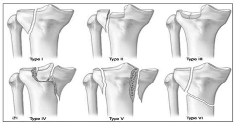 Tibial Plateau Fracture Classification