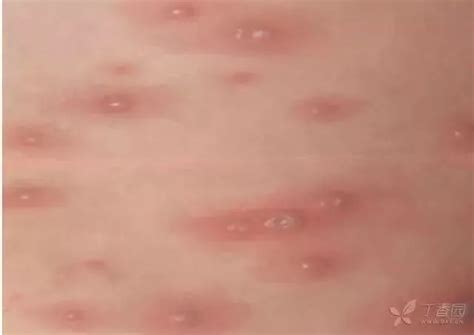 实用！10 种儿童皮疹疾病鉴别要点