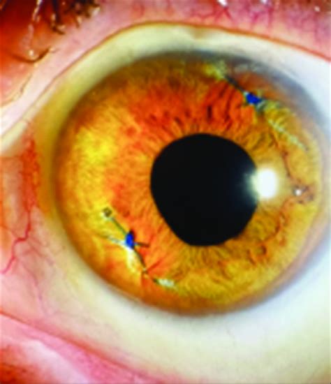 Example Of Iris Sutured Intraocular Lens Download Scientific Diagram