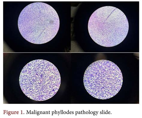 Scientific Research Publishing On Linkedin Phyllodes Tumors Breast Neoplasms Neoplasm Recurrence