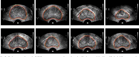 Figure 10 From Robust Prostate Segmentation Using Intrinsic Properties Of Trus Images Semantic