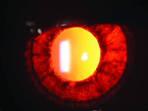 Fundo De Albinismo Ocular Hipoplasia Foveal Relacionada Ao Albinismo