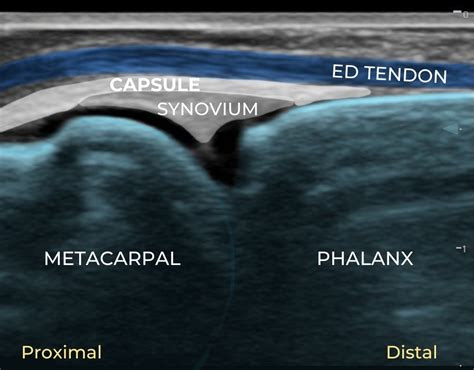 Hand Msk Ultrasound Rita Chorba Dpt