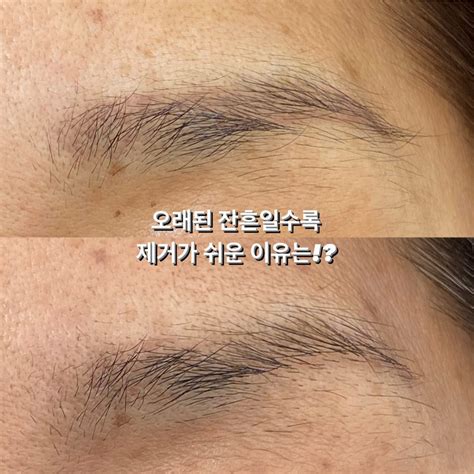 부산눈썹문신제거 원탑 브로우페페🥇잔흔제거수강 오래된 상승형 잔흔 때문에 인상이 사나워보여 제거 후 작업으로 진행한 고객님입니다 오래된 잔흔은 상대적으로 제거가 쉬운