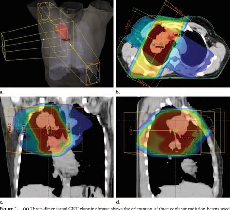 Lung Cancer Radiation Treatment