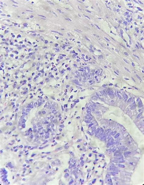 Histopathological Study Of Biopsy From Stenosing Exophytic Tumor Of The