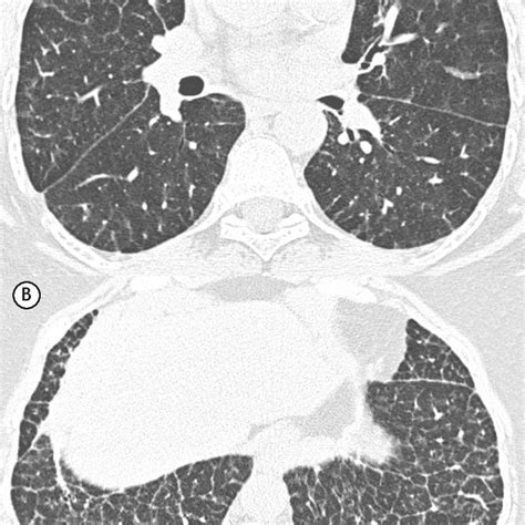 Pdf Niemann Pick Disease Type B Hrct Assessment Of Pulmonary Involvement
