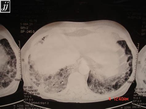 Chest Multiple Pulmonary Lesions 4 Radioogle