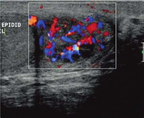 Color Doppler Sonography Reveal Increased Vascularity Of The Epididymal