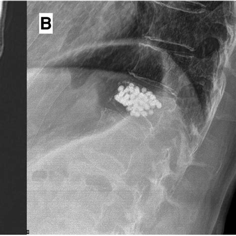 In This Case A 76 Year Old Woman With Vertebral Compression Active