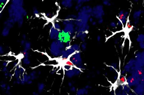 Researchers Propose A New Treatment For Brain Metastasis Based On Immunotherapy