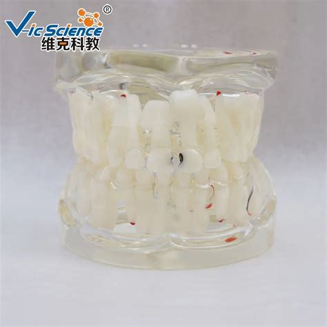 Anatomical Model Of Deciduous Permanent Teeth With Alternating Caries
