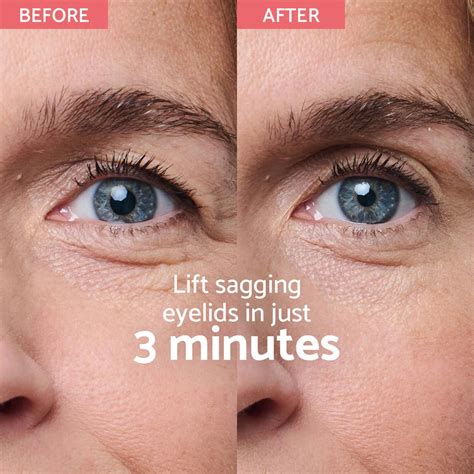 Droopy Eyelid Before And After Dr Moupia Goswami Eyes N Face