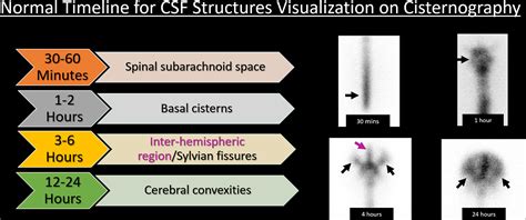 Nuclear Cerebrospinal Fluid Imaging Guide To Procedures And