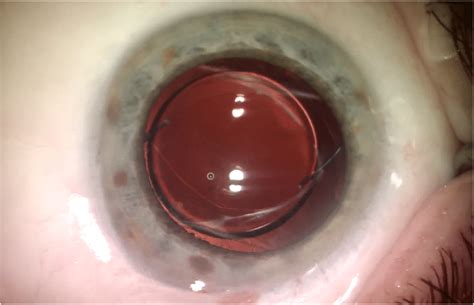 Intraoperative Image Of The Ar40e Iol Implanted In The Ciliary Sulcus