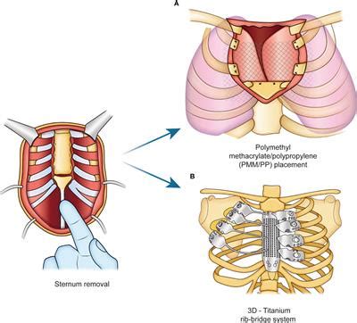Frontiers The Sternum Reconstruction Present And Future Perspectives