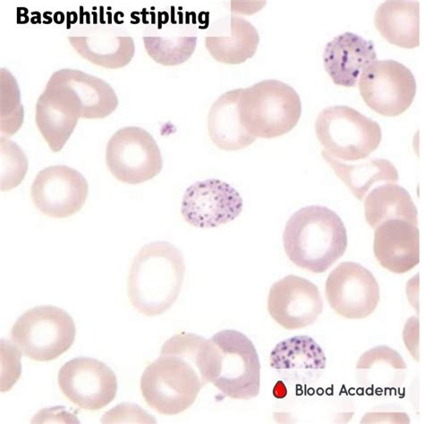 Basophilic Stippling Also Known As Punctate Basophilia Blood Academy