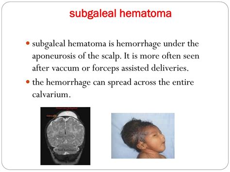 Subgaleal Hematoma Pediatrics Céphalhématome Sous Galeal Définition